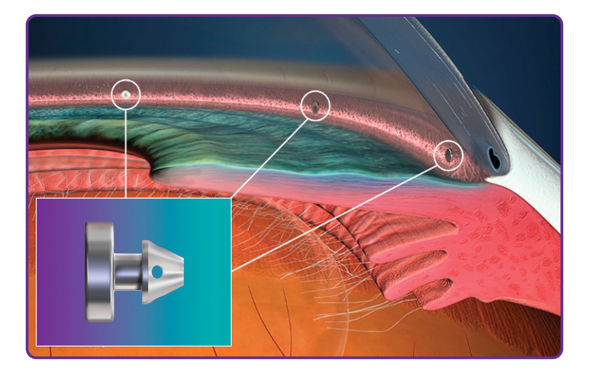 iStent Infinite Announcement | Glaucoma Australia